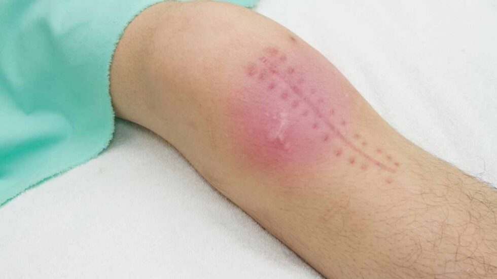 What is Limb Salvage Surgery? - Dr. Chetan Anchan