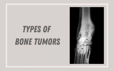 What Are The Different Types Of Bone Tumors? - Dr. Chetan Anchan
