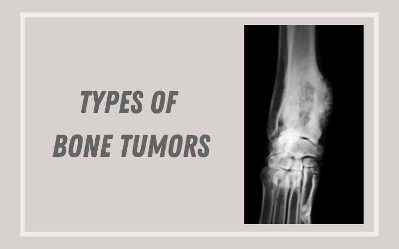 Can Bone Tumors In Dogs Be Benign Can Bone Tumors In Dogs Be Benign